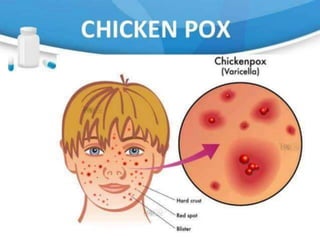 Chicken pox | PPT