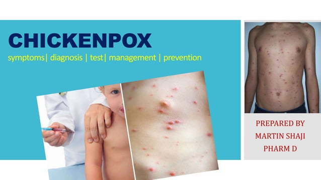 Chickenpox -symptoms |tests |management ( medical information ) | PPTX ...