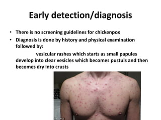 Chicken pox | PDF
