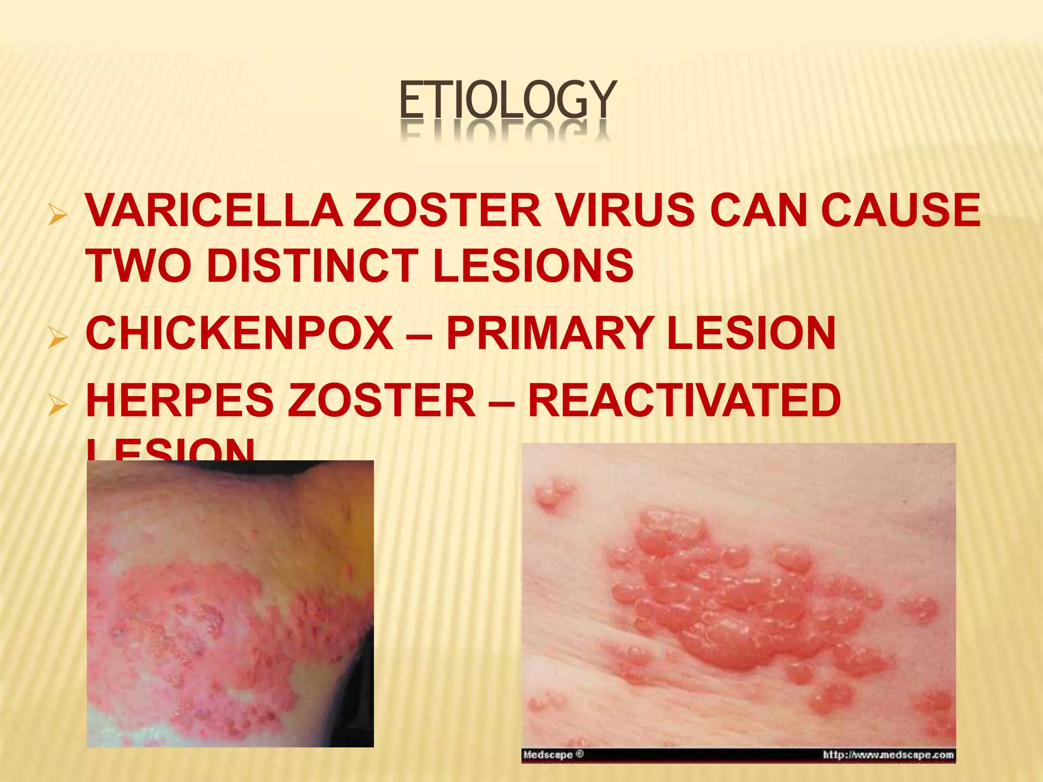 Chickenpox | PPTX