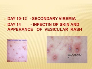 Chickenpox | PPTX