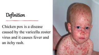 Chicken Pox.pptx