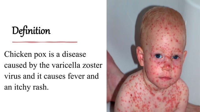 Chicken Pox.pptx