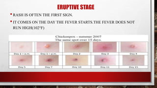 chickenpox | PPT