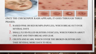 chickenpox | PPT