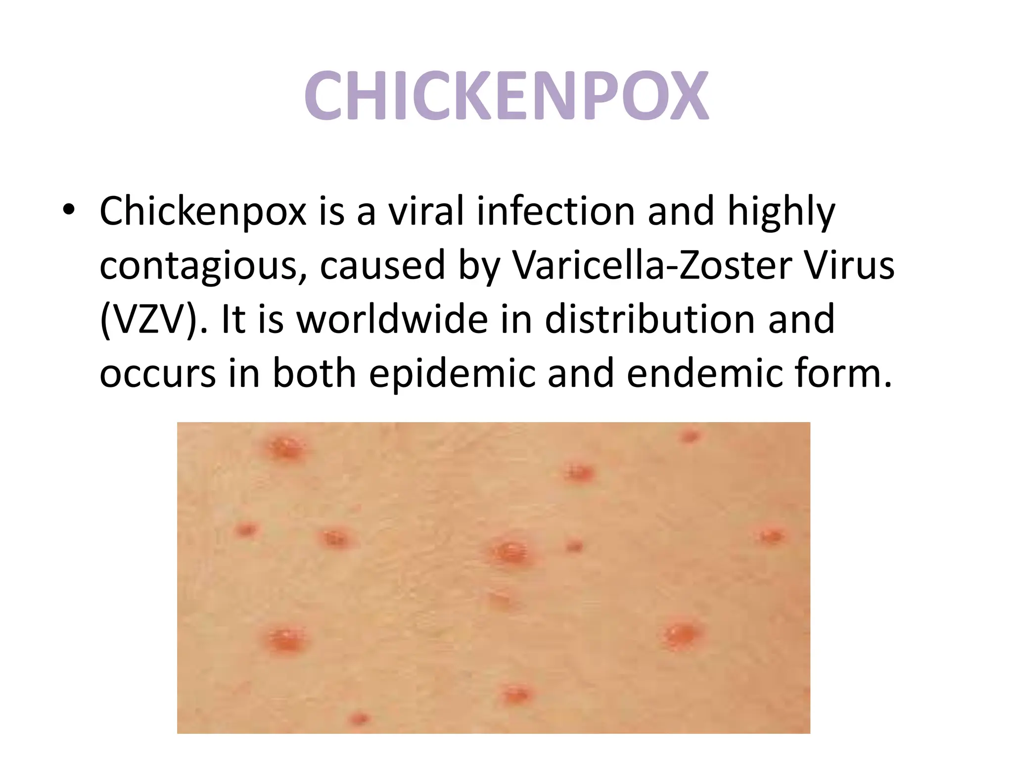 COMMUNICABLE DISESE, CHICKEN POX ADULT HEALTH NURSING PPT | PPTX