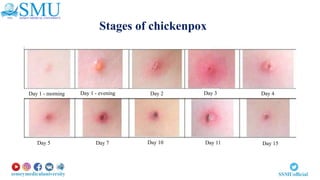 Chickenpox in children ppt for medical students | PPT