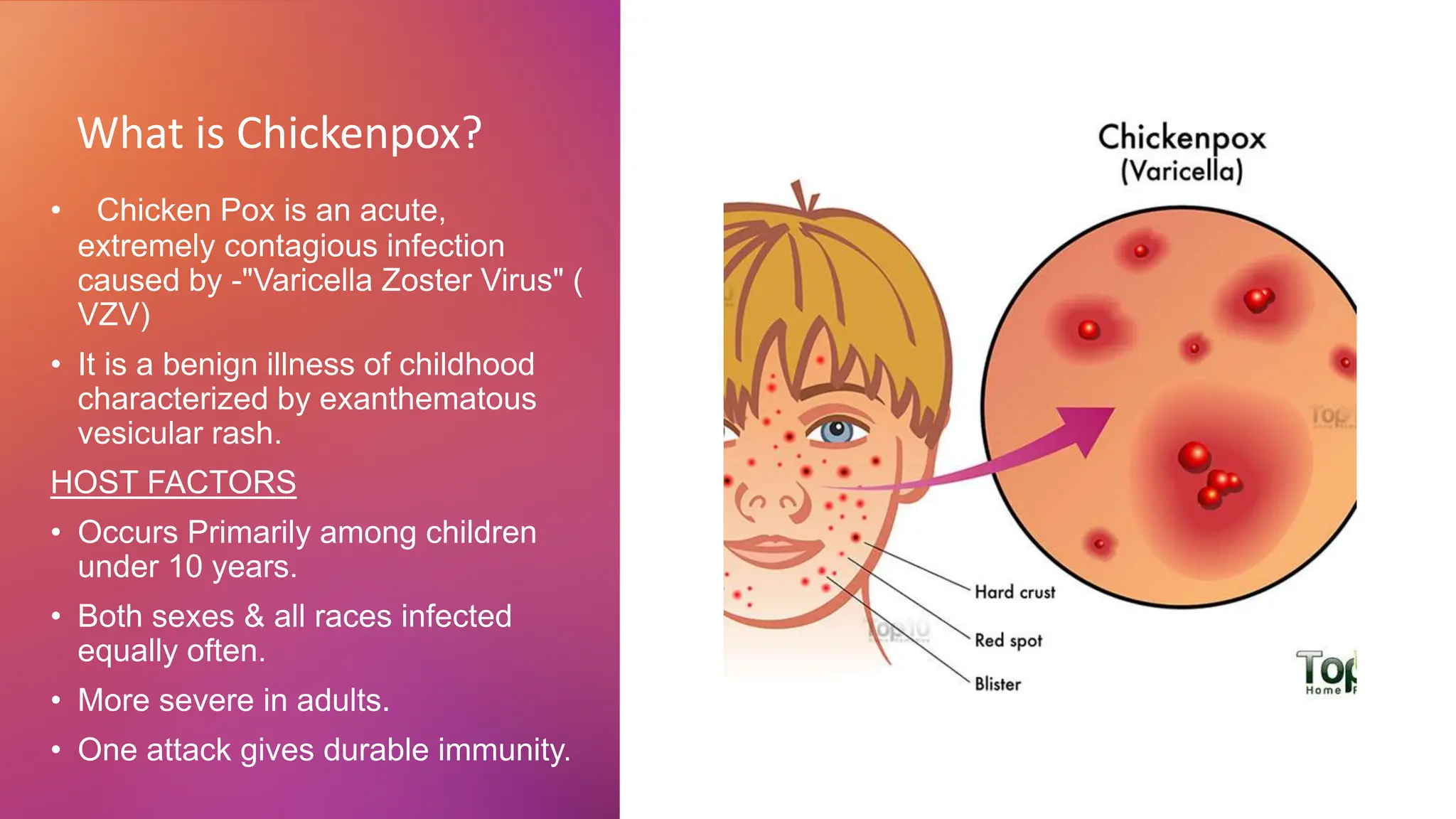 CHICKEN POX varicella Zoster Virus.pptx