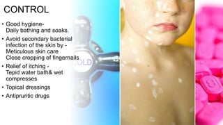 CHICKEN POX varicella Zoster Virus.pptx