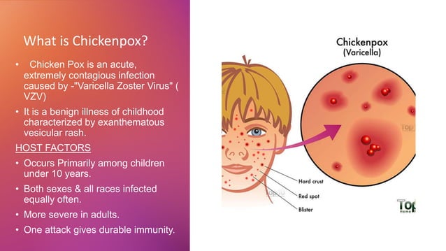 CHICKEN POX varicella Zoster Virus.pptx