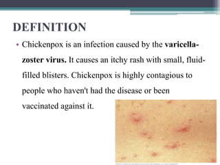 CHICKENPOX.pptx