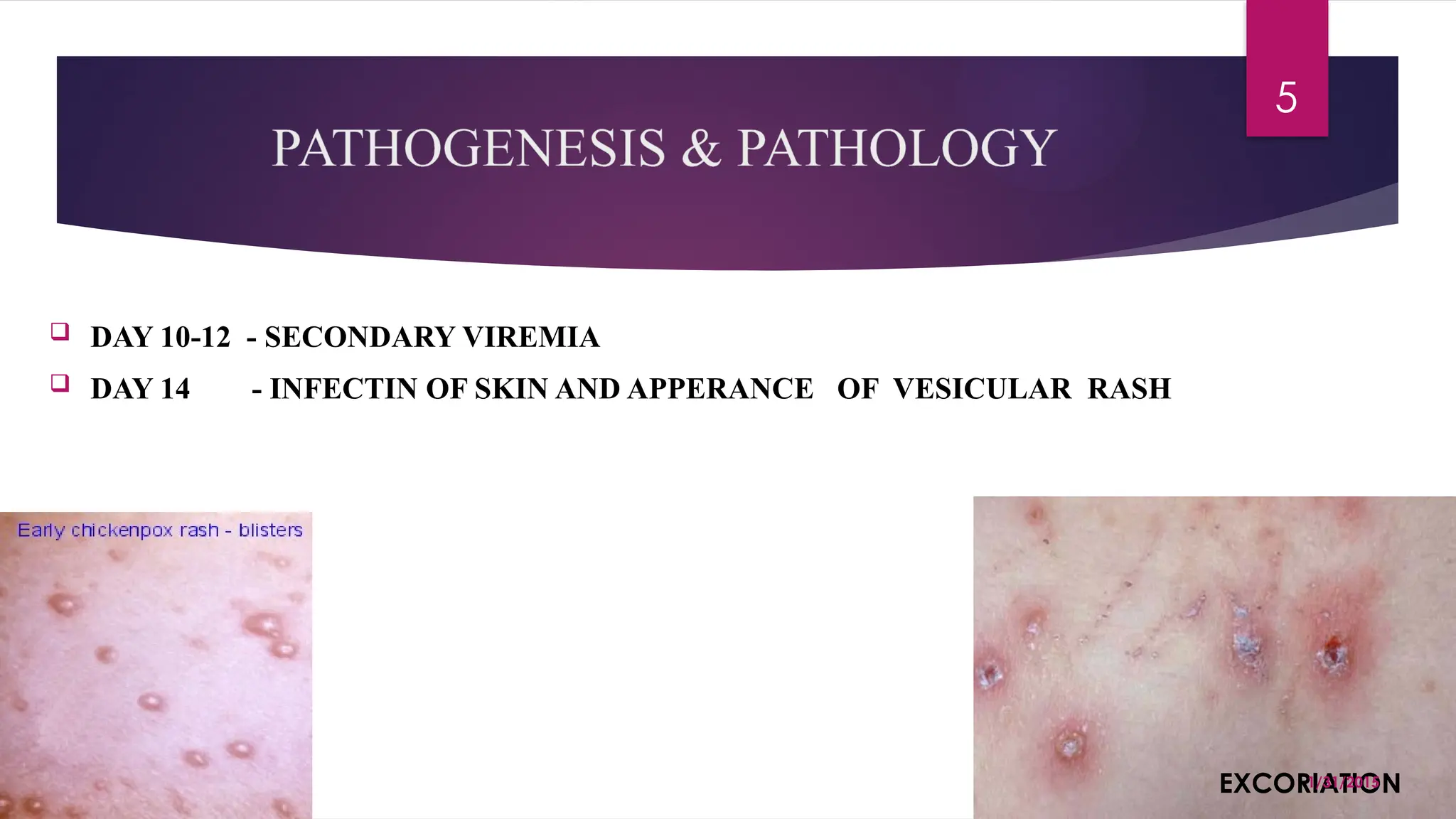 chicken pox.pptx disease chicken pox is harmful | PPT