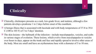 chicken pox.pptx disease chicken pox is harmful | PPTX