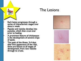 Chickenpox Presentation | PPT