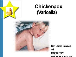 chickenpox-presentation in children medical | PPTX
