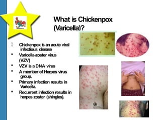 chickenpox-presentation in children medical | PPTX