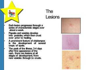 chickenpox-presentation in children medical | PPTX
