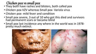 Chickenpox Varicella zoster virus.VZV FIJI | PPTX