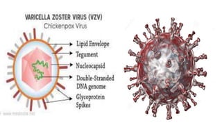 Chickenpox Varicella zoster virus.VZV FIJI | PPTX