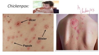 Chickenpox and Smallpox.PSM,COMMUNITY MEDICINE,DR NARENDRA KUMAR YADAV ...