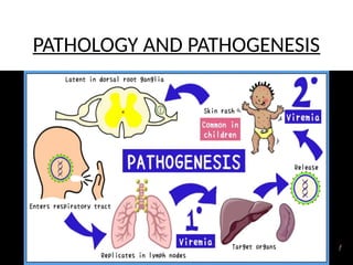 CHICKEN POX diagnosis and management ppt | PPTX