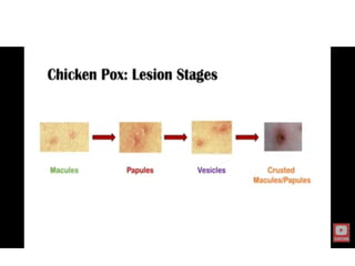 CHICKEN POX diagnosis and management ppt | PPTX