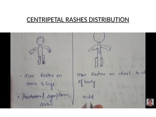 CHICKEN POX diagnosis and management ppt | PPTX