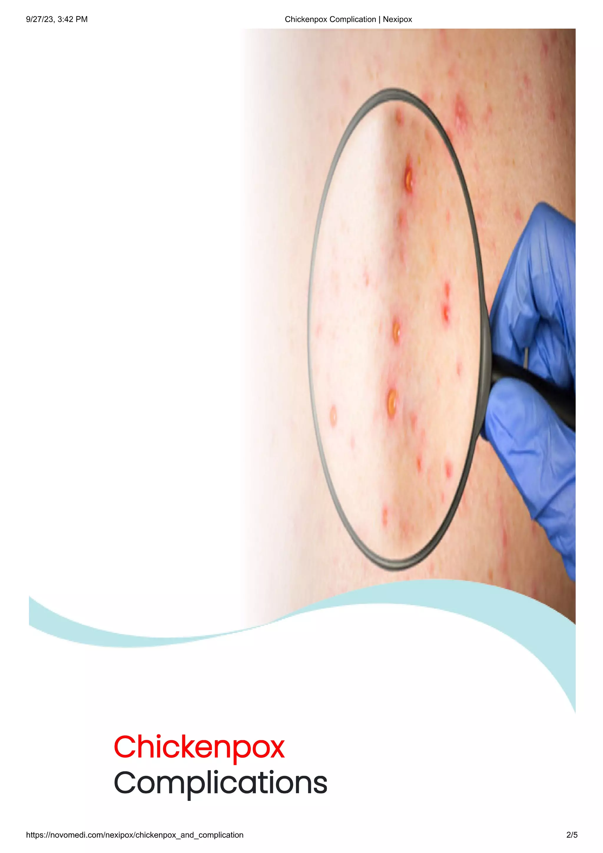 Chickenpox Complications.pdf