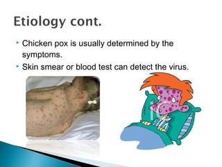 Chicken pox jenny leach | PPT