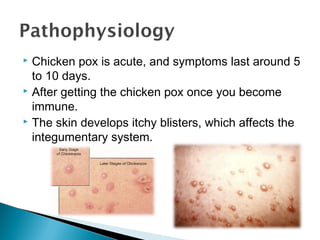 Chicken pox jenny leach | PPT