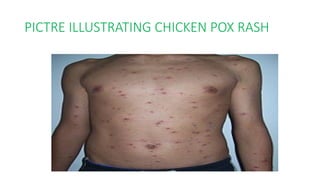 CHICKEN POX Presentation by john k f.pptx