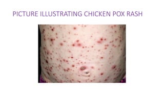 CHICKEN POX Presentation by john k f.pptx