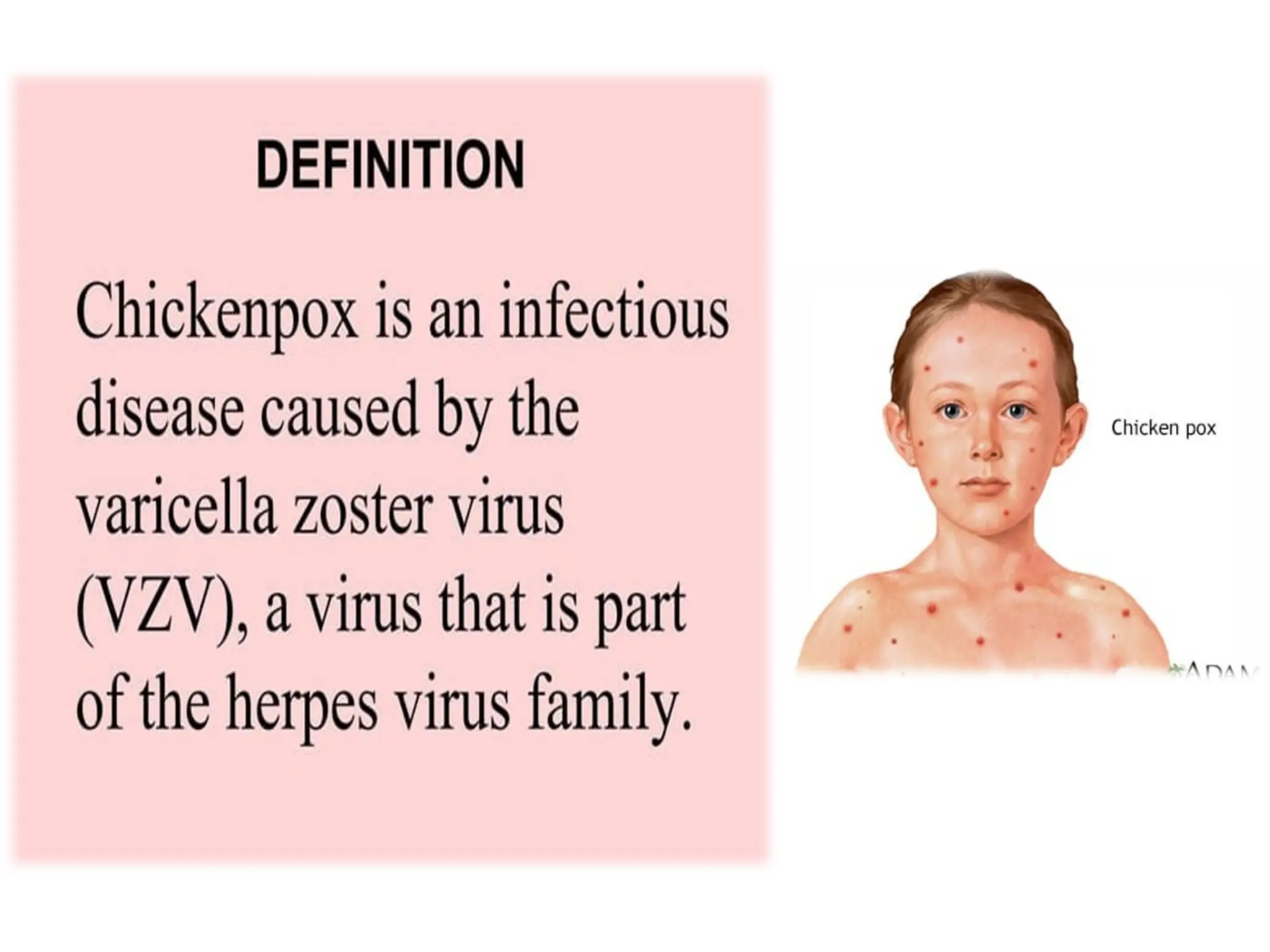 case presentation on chickenpox ppt chn.pptx