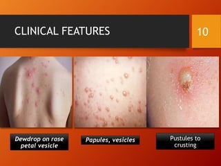 Chicken pox & Shingles | PPTX