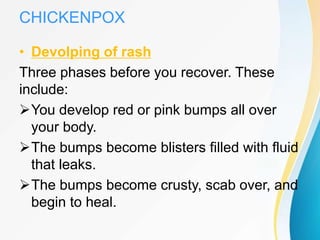 chickenpox & shingles.ppt
