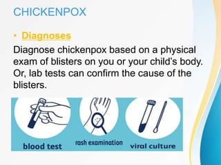 chickenpox & shingles.ppt