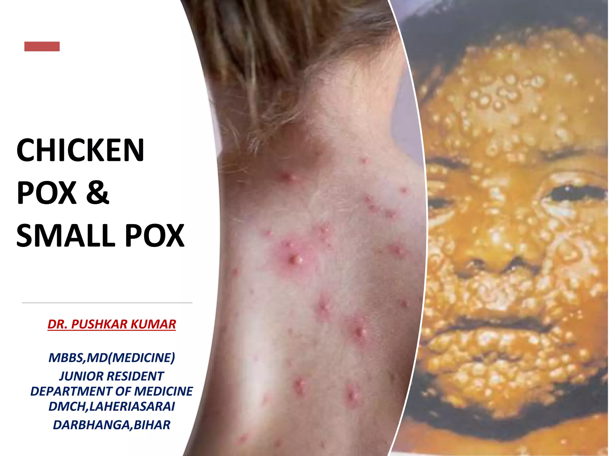 Chicken Pox & Small Pox.pptx