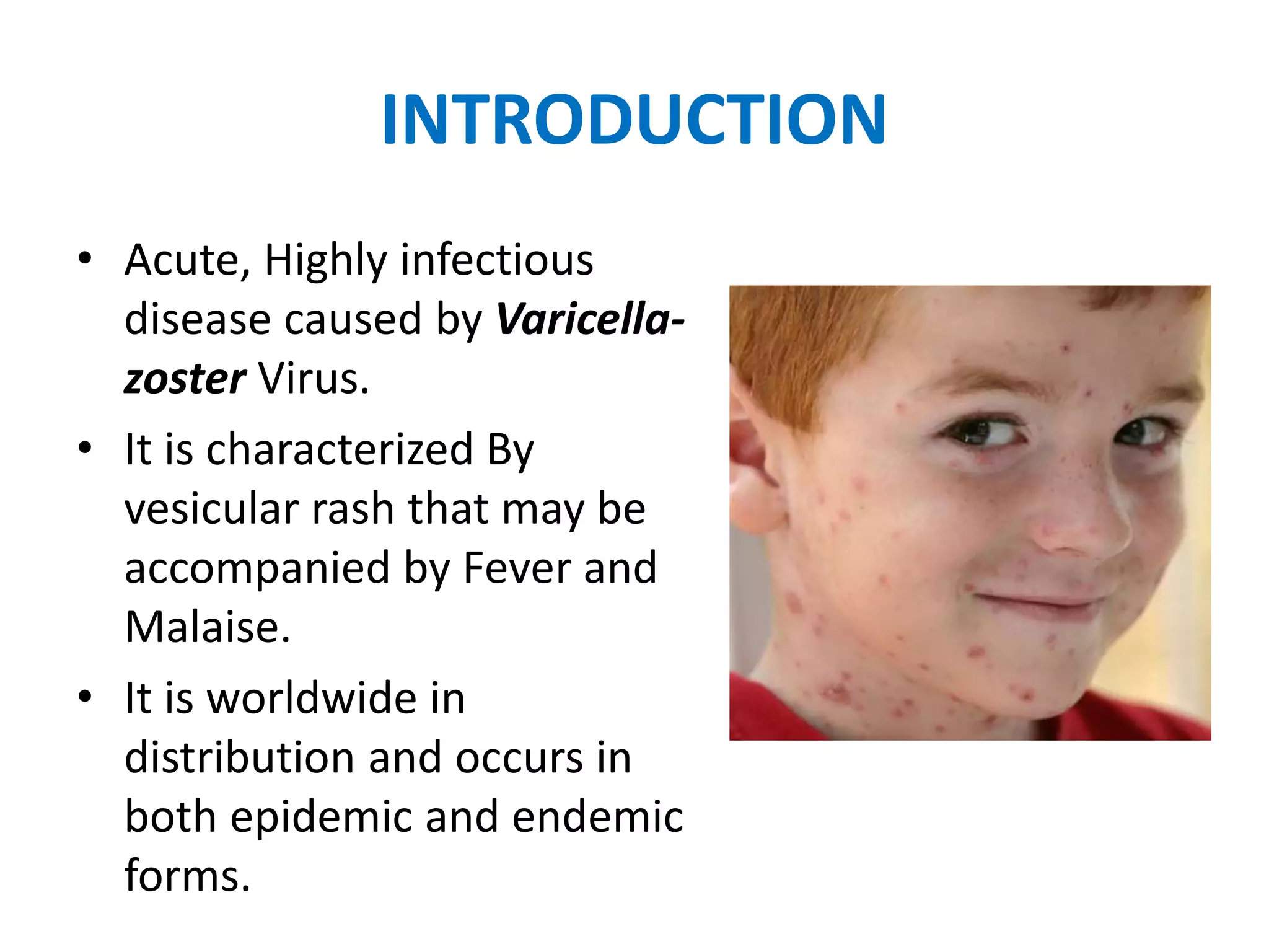 Chicken pox (varicella) | PPTX