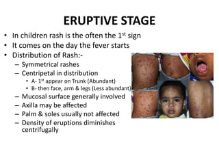 Chicken pox (varicella) | PPTX