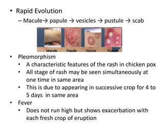 Chicken Pox Macule