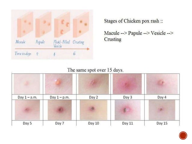 CHICKENPOX (VARICELLA).pptx | Infectious Diseases | Diseases and Conditions