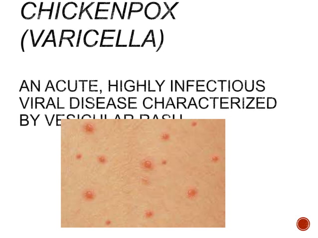 CHICKENPOX (VARICELLA).pptx | Infectious Diseases | Diseases and Conditions