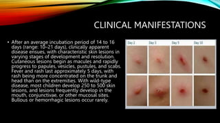 Chicken pox(varicella).pptx