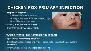 CHICKEN POX (VARICELLA).pptx varicella zoster | PPTX