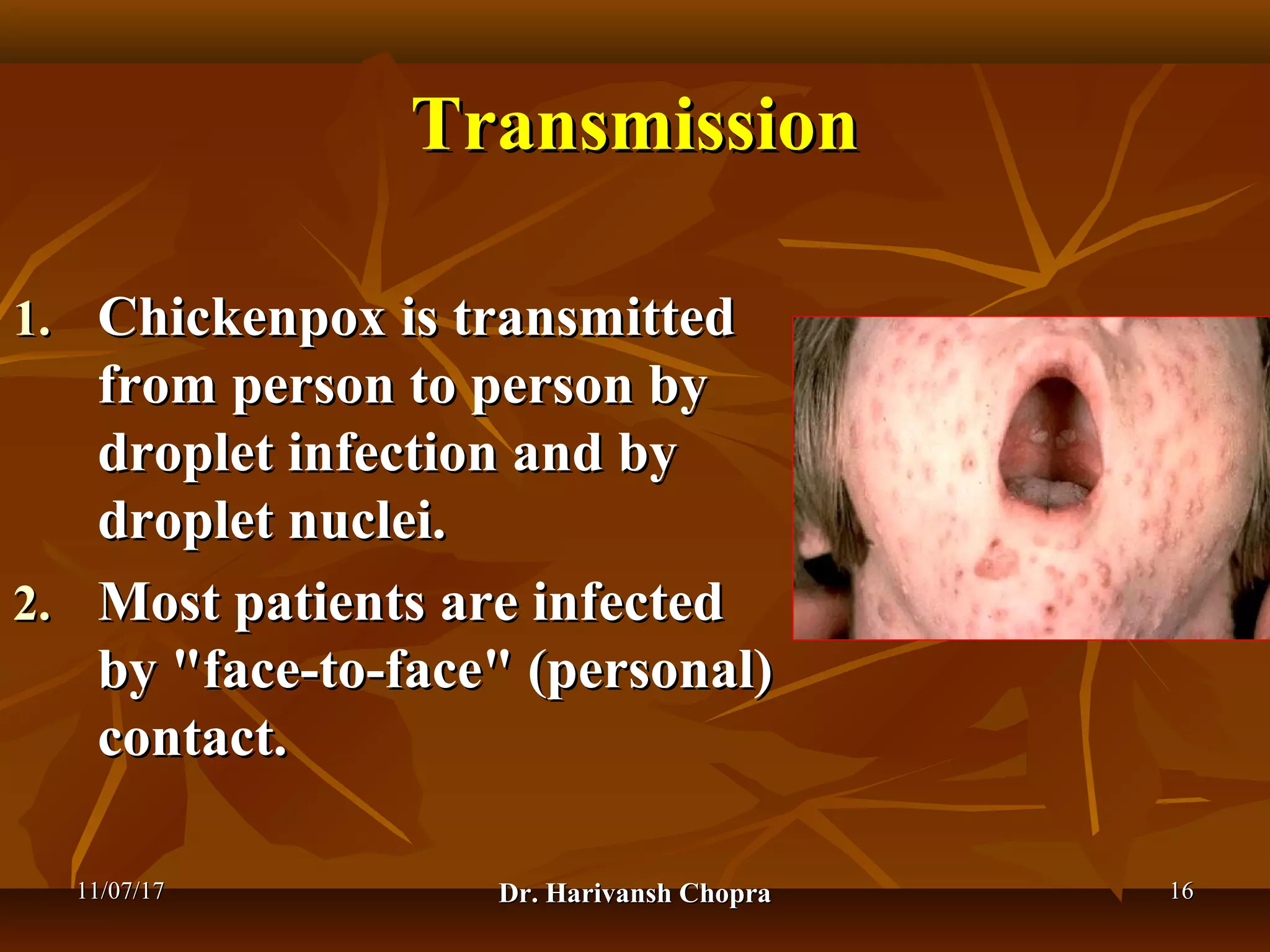 Chickenpox (varicella) dr harivansh chopra | PPT