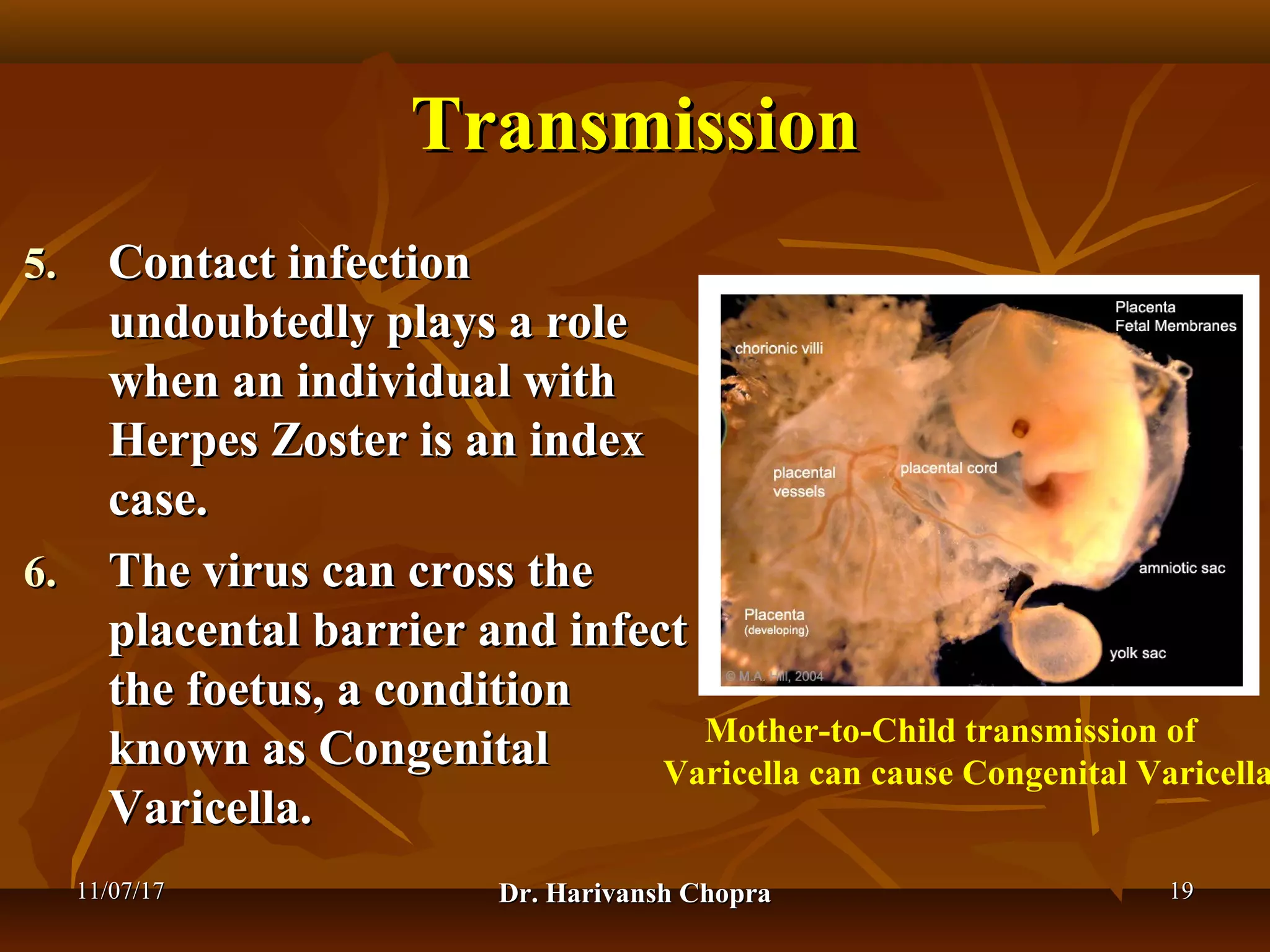 Chickenpox (varicella) dr harivansh chopra | PPT