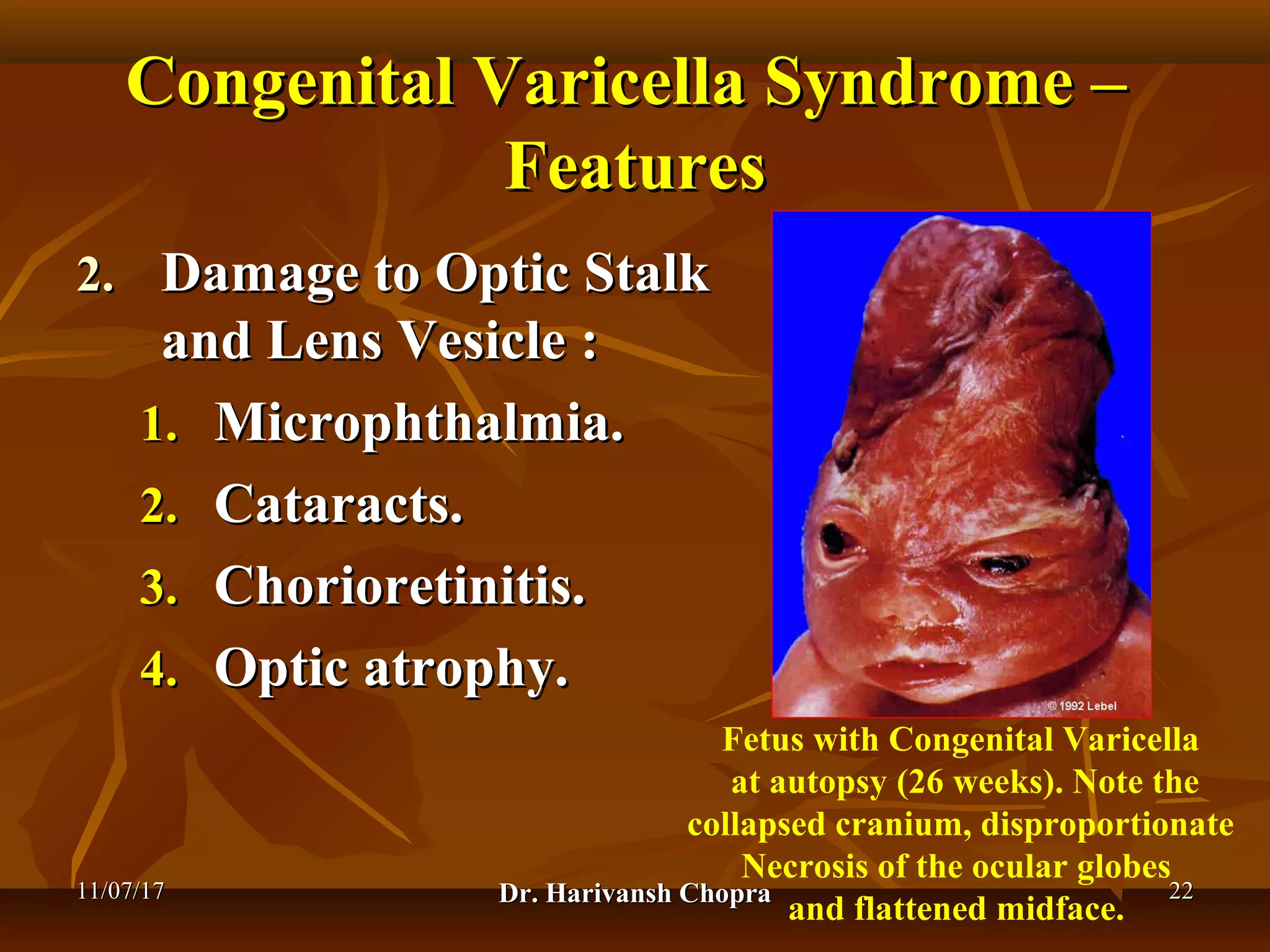 Chickenpox (varicella) dr harivansh chopra | PPT