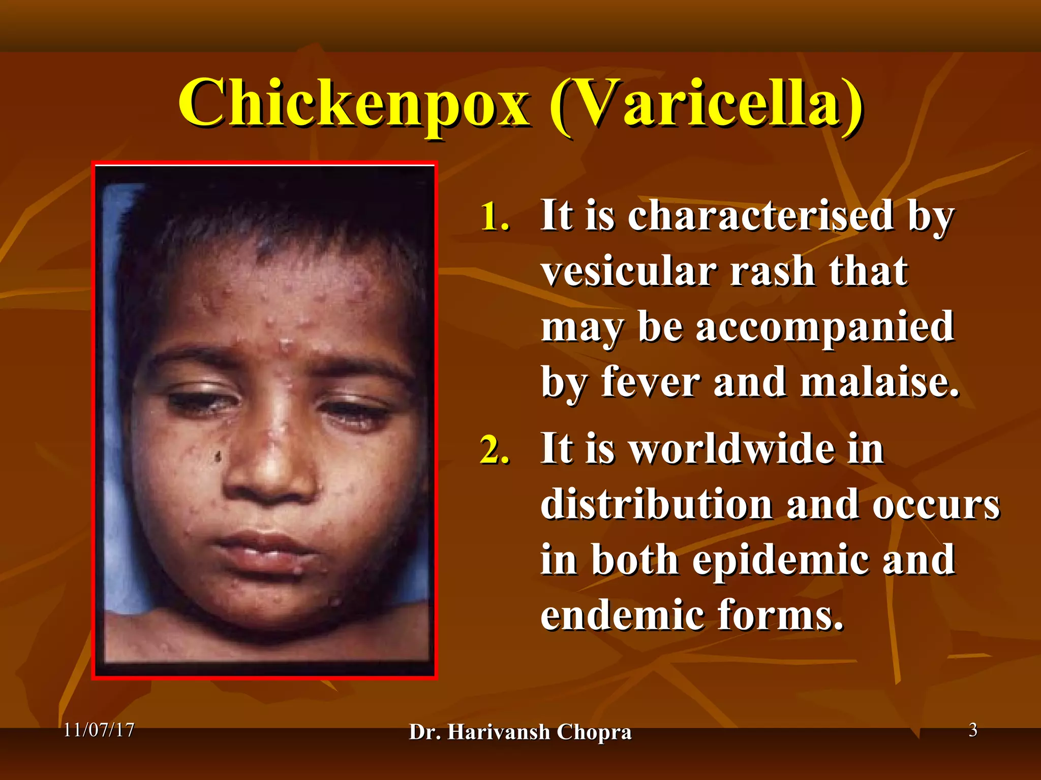 Chickenpox (varicella) dr harivansh chopra | PPT