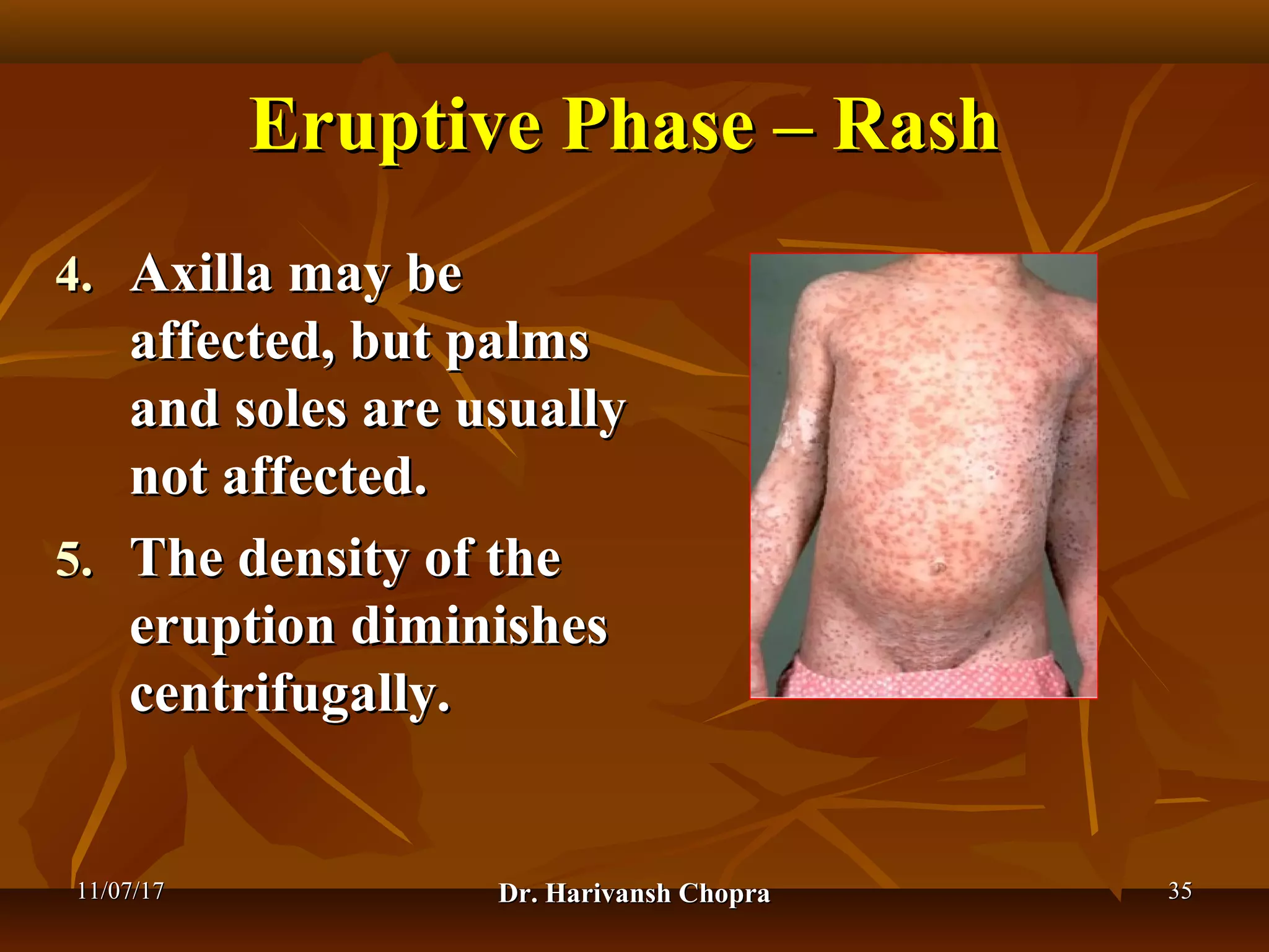 Chickenpox (varicella) dr harivansh chopra | PPT