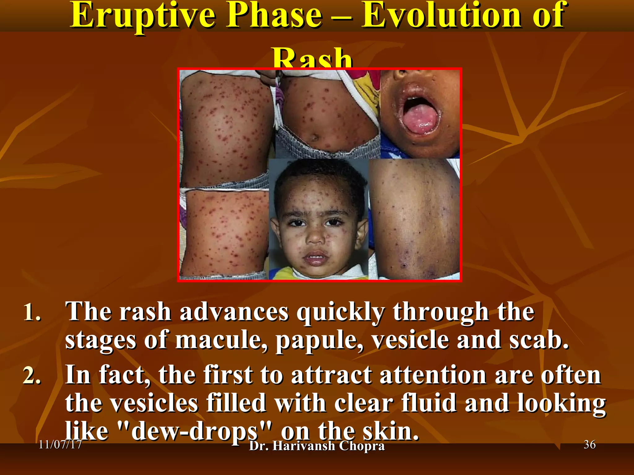 Chickenpox (varicella) dr harivansh chopra | PPT